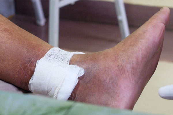 Leg Wound Treatment in Michigan | Miller Vein