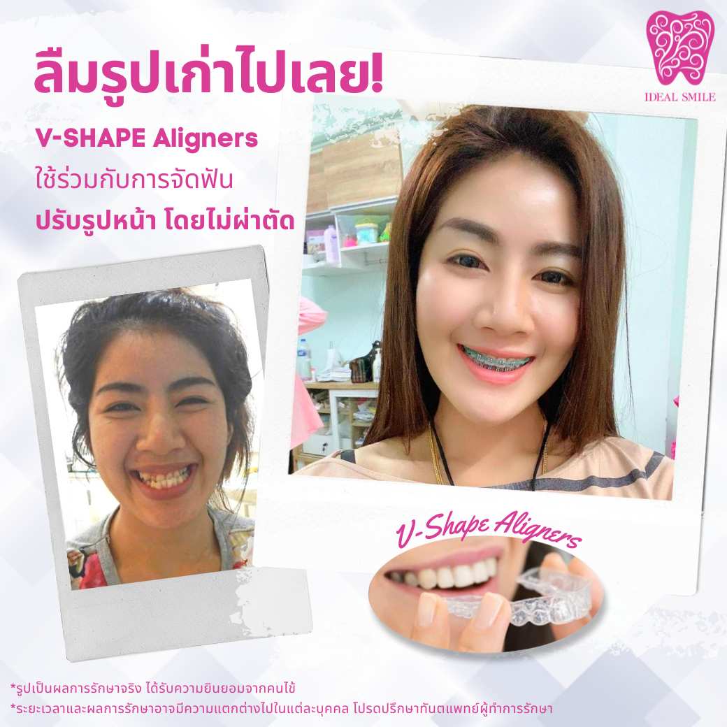 09 V-SHAPED Aligners