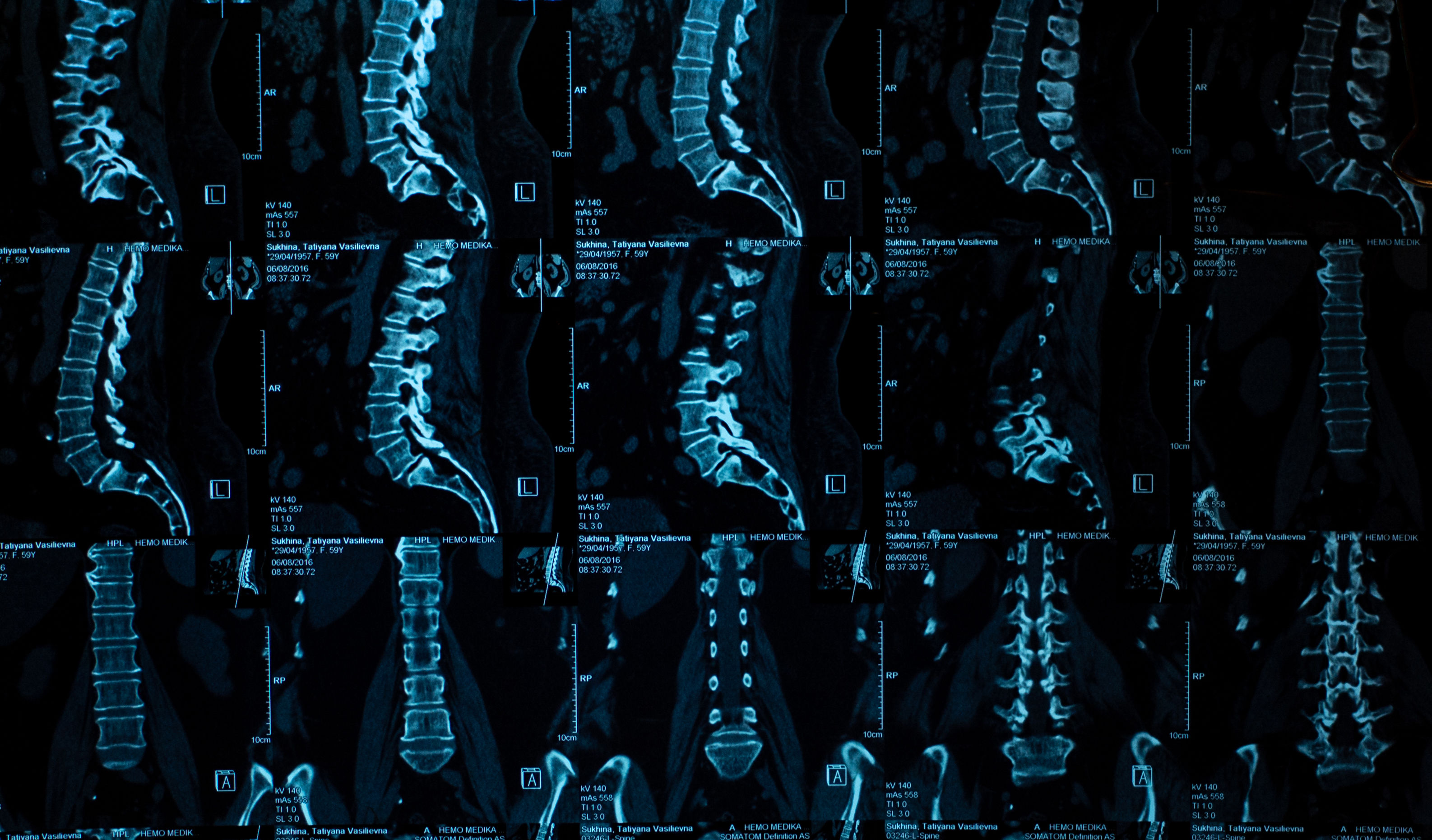Astellas and Avexis Collaborate on Gene Therapy for Spinal Muscular Atrophy