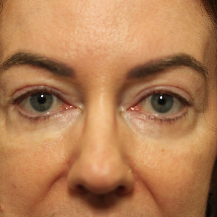 Before and After LOWER EYELID RETRACTION | Robert Schwarcz MD