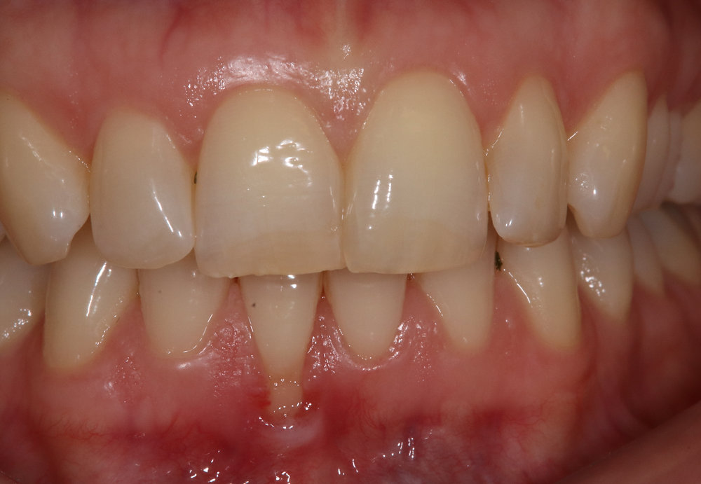 Gingival Recession... what next?