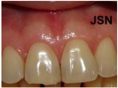 O Periodonto e a Gengiva