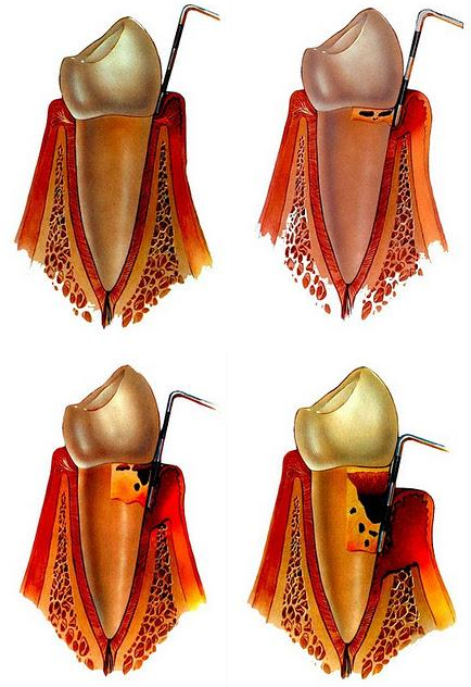 A Doença Periodontal