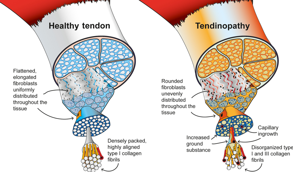 GLUTEAL TENDINOPATHY