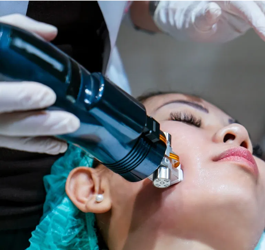 Trending Treatments: Radio Frequency Microneedling