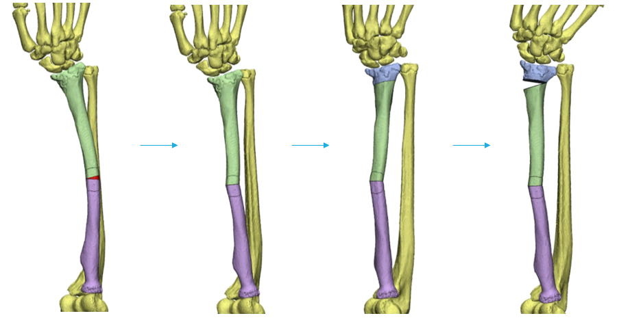 Radius Deformity Correction with 3D Printed patient-specific instruments