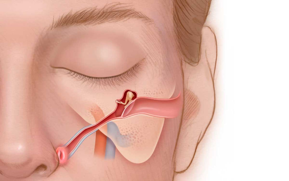 Eustachian Tube Dysfunction ETD And How To Treat It