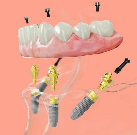 All-On-4® Dental Implants Adelaide