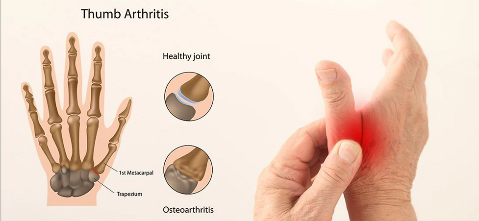 The Hand Physio Clinic Thumb Arthritis Sydney Hand Therapy