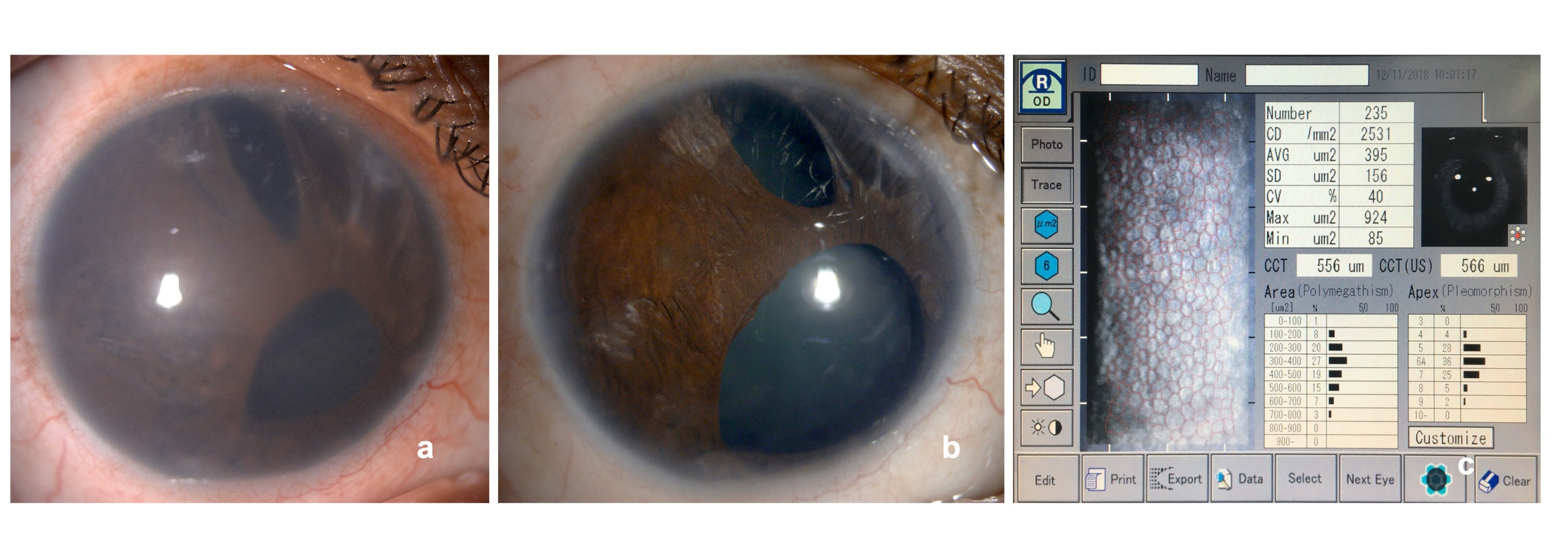 Revolutionizing Corneal Surgery: Dr. K.S. Siddharthan's Journey at Eyemed Hospital & Cornea ...