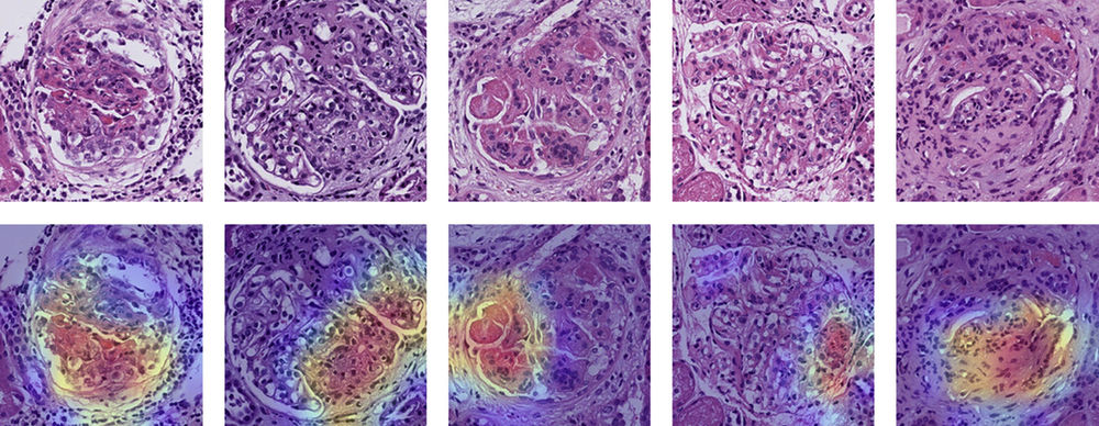 Glomerular disease classification and lesion identification by machine ...