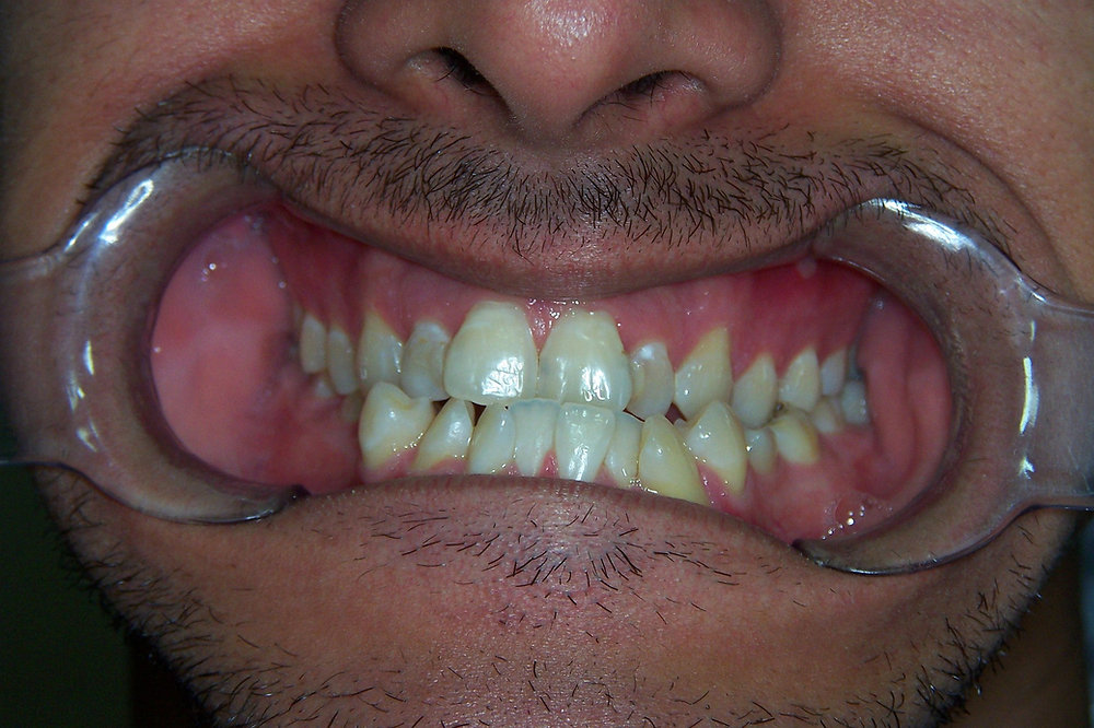 WHAT ARE THE NEGATIVE EFFECTS OF MALOCCLUSION (MISALIGNED BITE)?