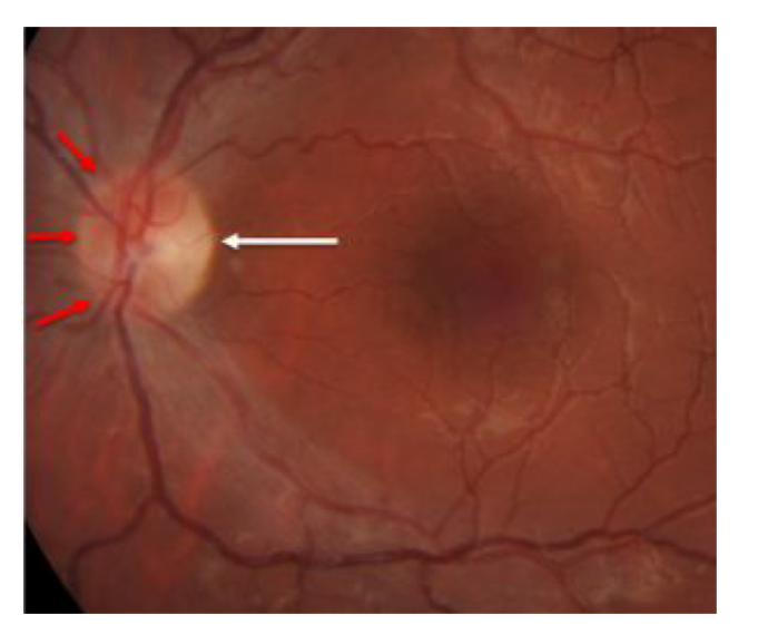 Neuropatia Óptica Hereditária de Leber - Uma doença Silenciosa