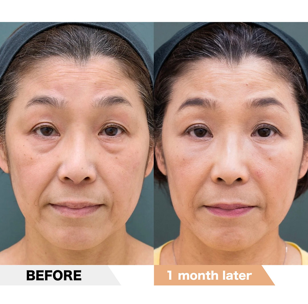 Lower eyelid groove under eyes, Smile lines, PRPF injection therapy