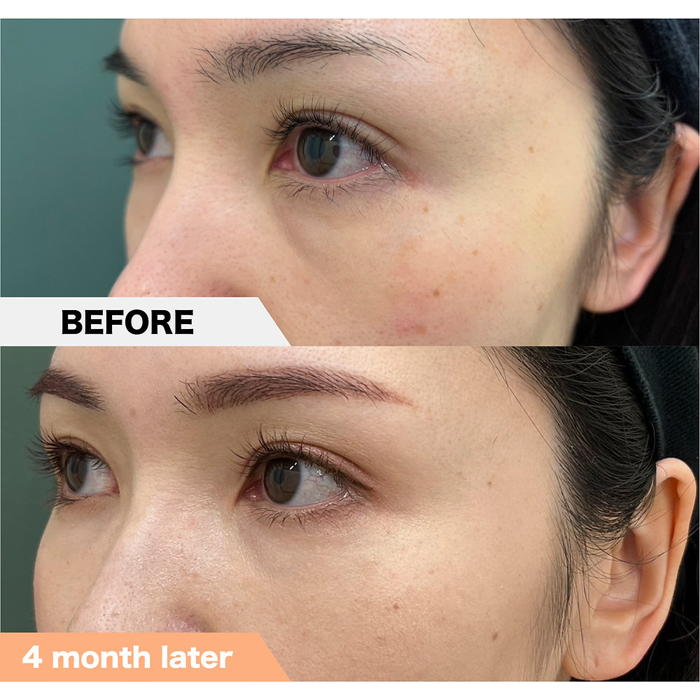 Lower eyelid groove under eyes PRPF injection therapy