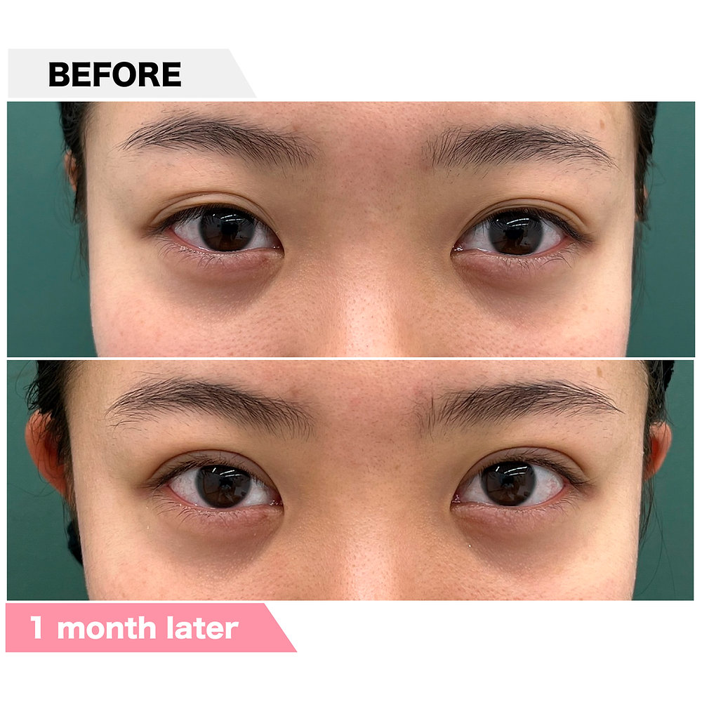 Total Incisional double eyelid plasty