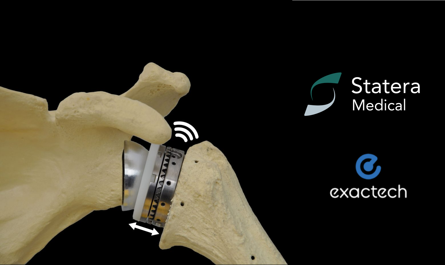 Statera Medical Partners with Exactech to Co-Develop World’s First ...