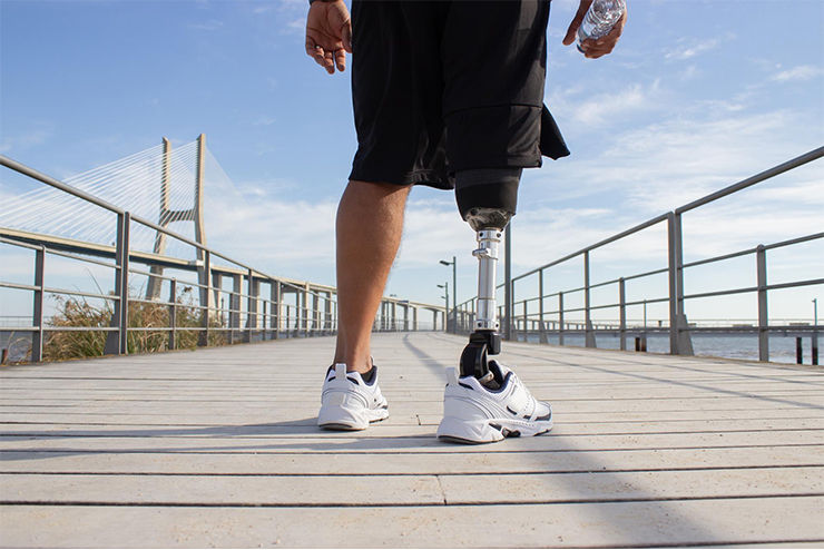 A Stepwise Guide to Getting A Prosthetic Leg | Lifeforce Hub