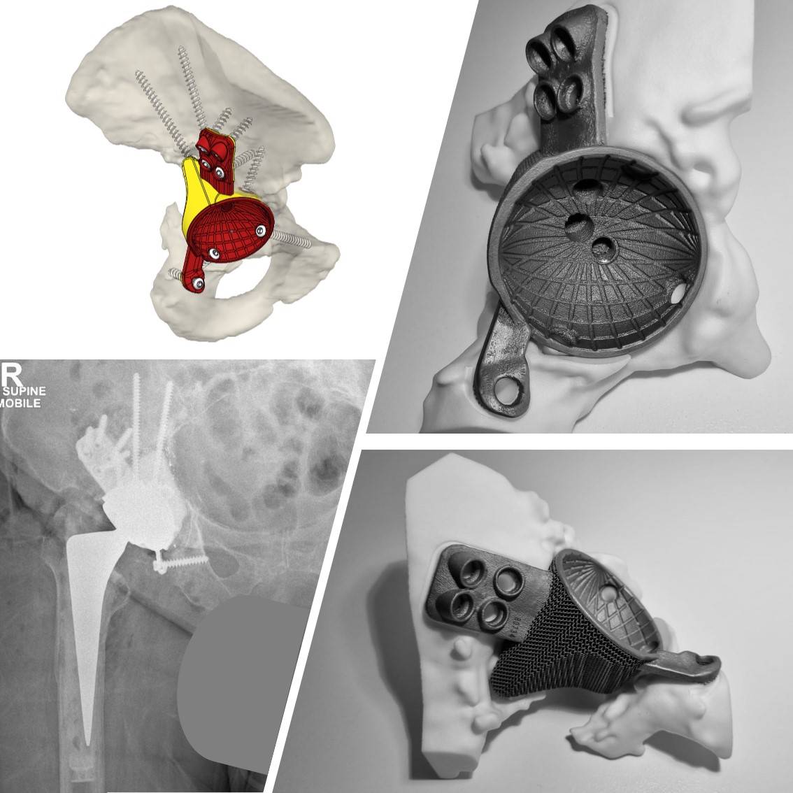 LRS CiS - Custom 3D-Printed Acetabulum