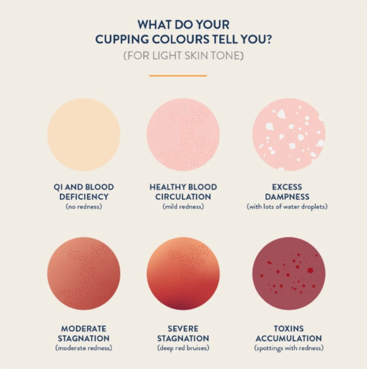 What are those?! Cupping marks - what are they and what can they tell ...