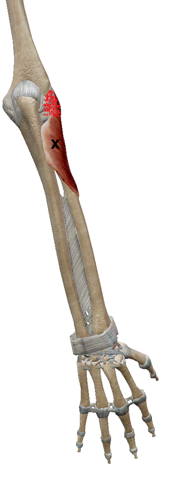 Epicondilite o trigger points miofasciale?