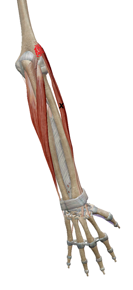 Epicondilite o trigger points miofasciale?