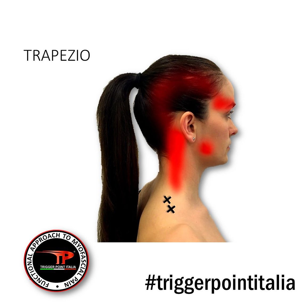 Efficacia delle tecniche integrate sui Trigger Points del trapezio superiore nel dolore cervicale no