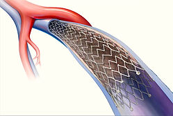 Venous TOS Treatment | TOS Outreach Network