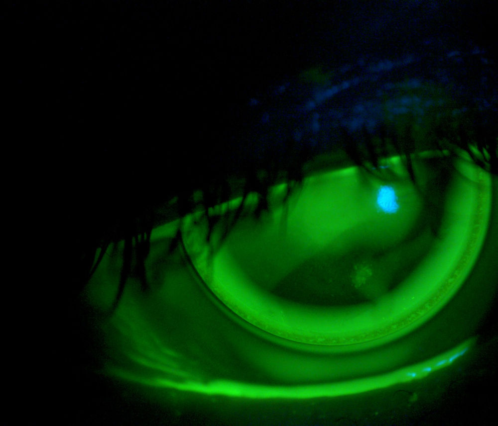 The Piggyback: RGP Contact Lenses paired with Rose-K2 Lenses