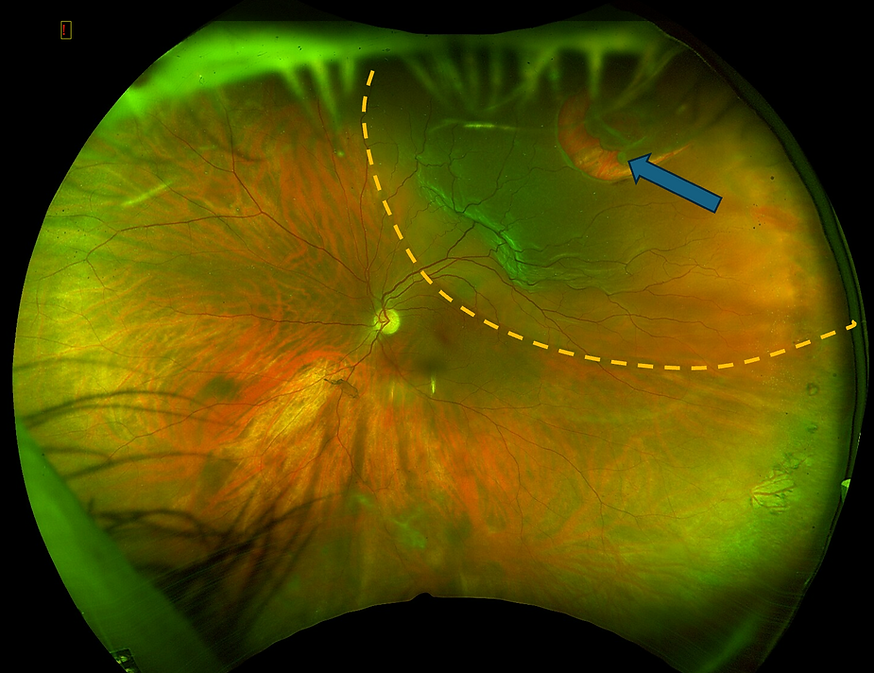 Retinal detachment | Dr Sky Chew