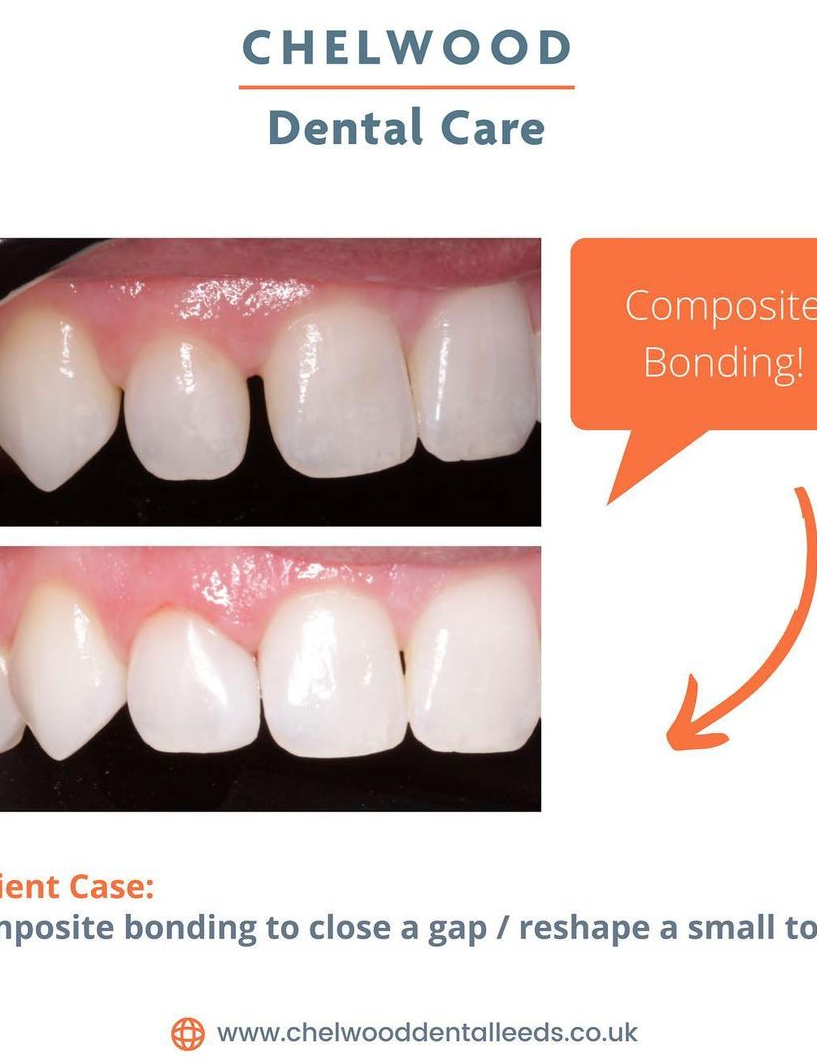 Composite Bonding vs Veneers