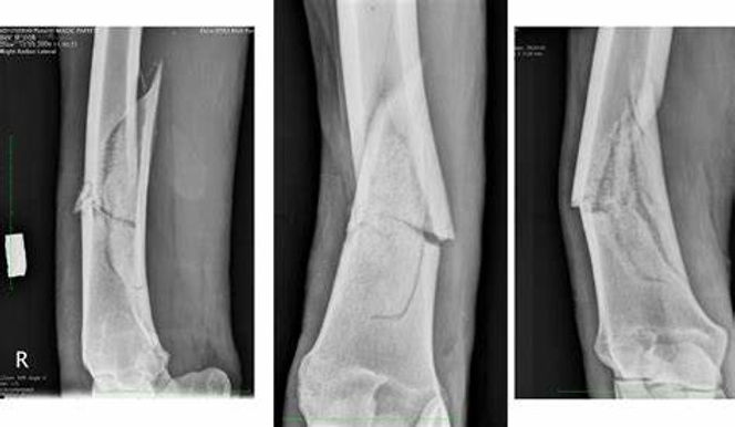 Displaced radial fractures in adult horses