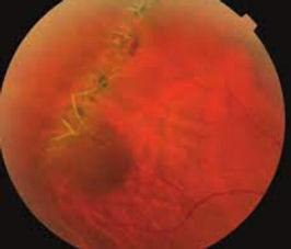 Lattice Degeneration | Washington Retina