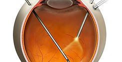 vitrectomy experience