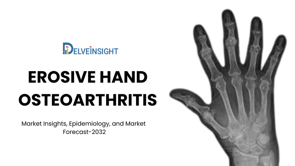 What is the Erosive Hand Osteoarthritis Market Share?