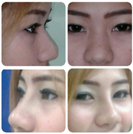 ศัลยกรรมเสริมจมูกและเก็บปีกจมูก