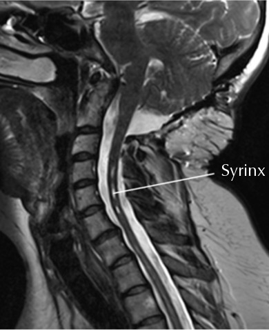 What is Syringomyelia | Chiari and Syringomyelia Australia