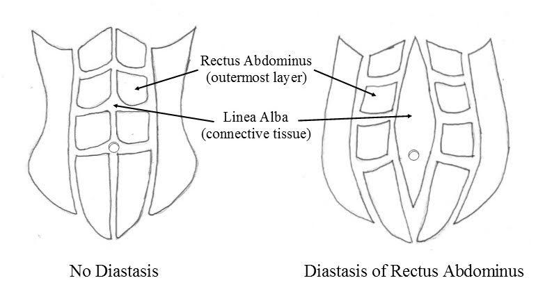 Diastasis Recti: Prevention and Treatment