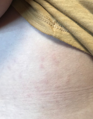 does bartonella rash itch