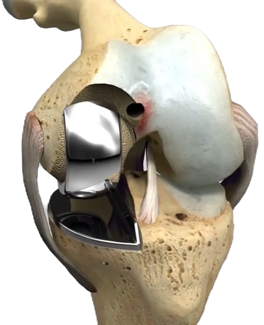 Knee Replacement Surgery London Knee Surgeon London Knee Replacement Surgery London Knee Surgeon London