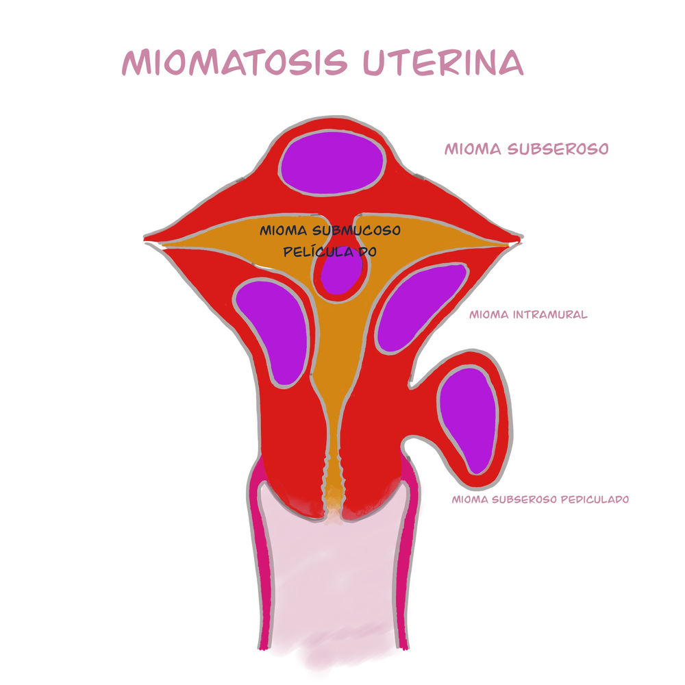 La miomatosis uterina, puede afectar a la fertilidad?