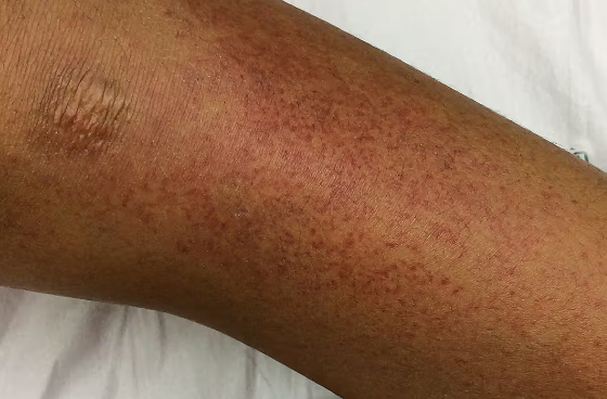 What are the types of bruises?