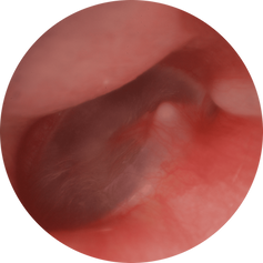 Sémiologie otoscopique | OTOscopic