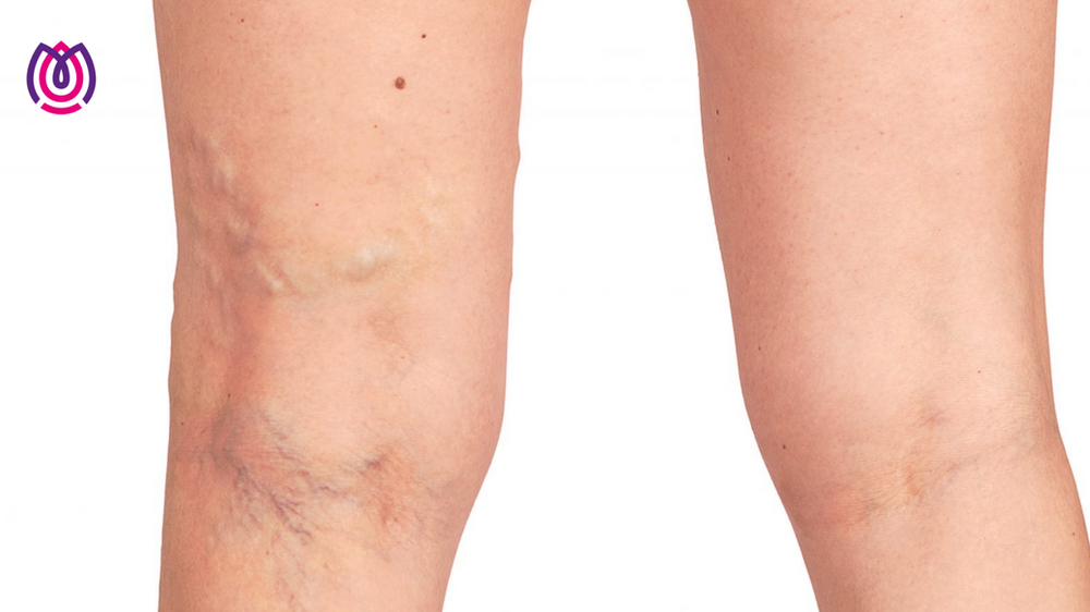 Trombose venosa profunda: o que é, causas, tratamentos e prevenção