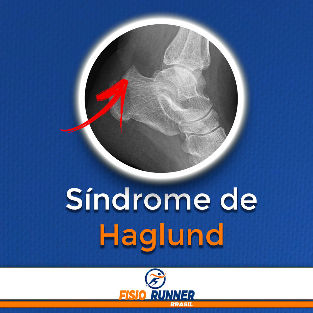 Síndrome de Haglund