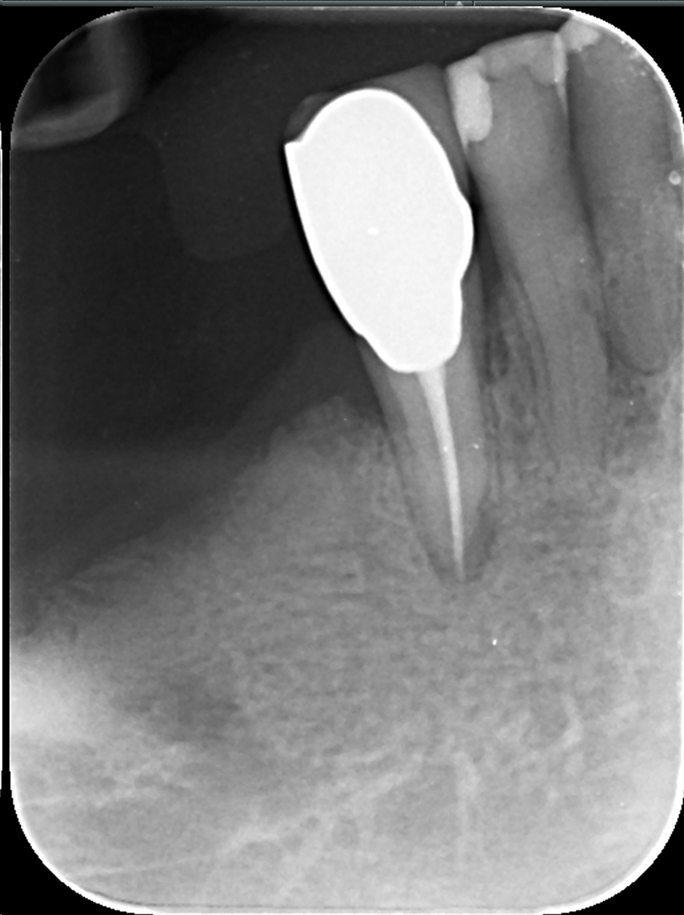 Treatment Gallery | Gold Coast Endodon 1