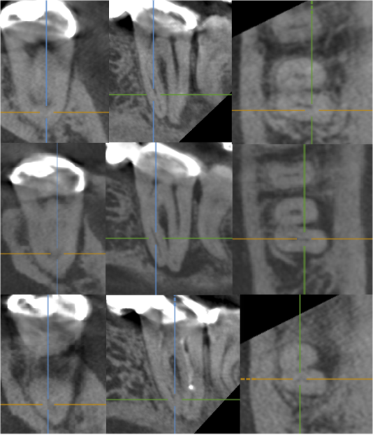 Treatment Gallery | Gold Coast Endodon 1