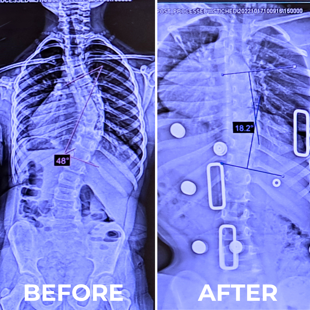 Scoliosis and Adam's Forward Bending Test