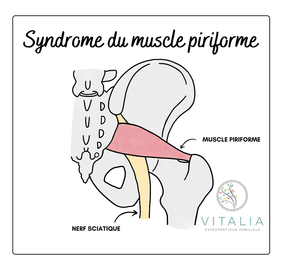 Le syndrome du piriforme