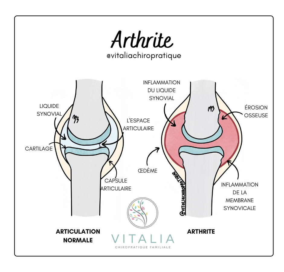 Arthrose, arthrite ou rhumatisme?